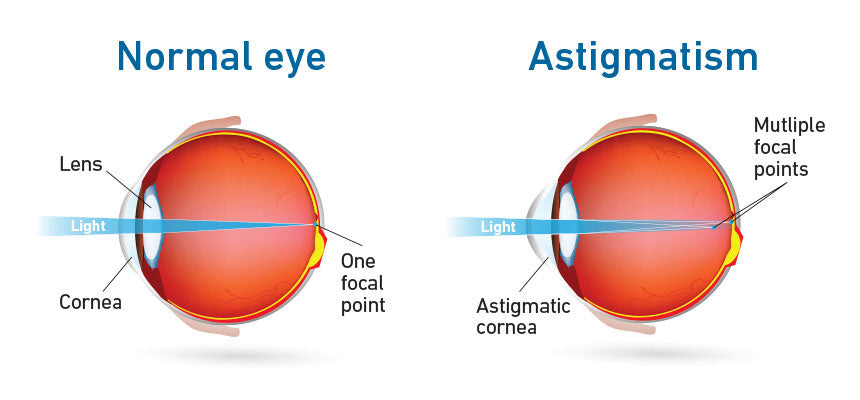 What is Astigmatism? – Vision Opticians